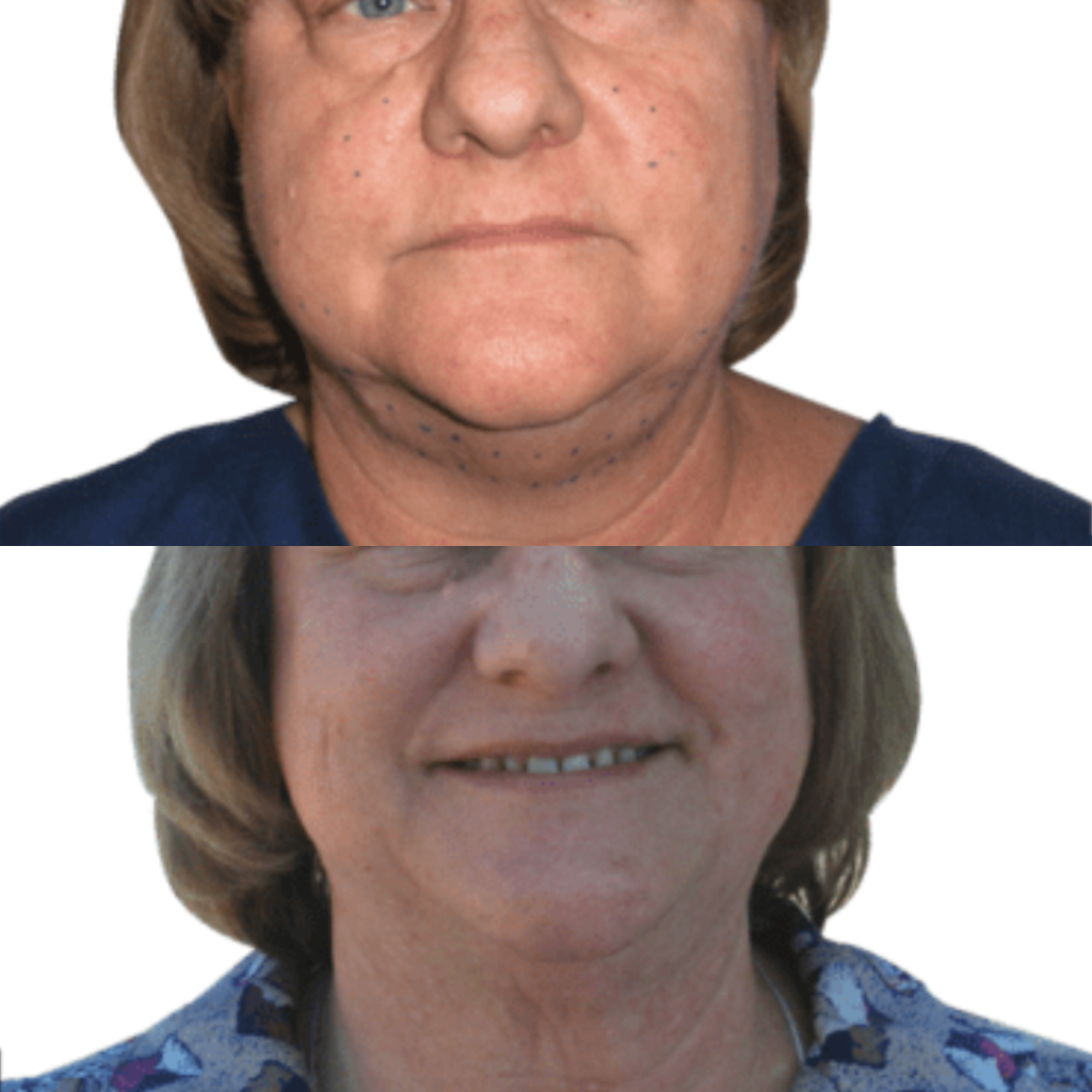 The Smart Lift - Dermacare Laser & Skin Care Clinics