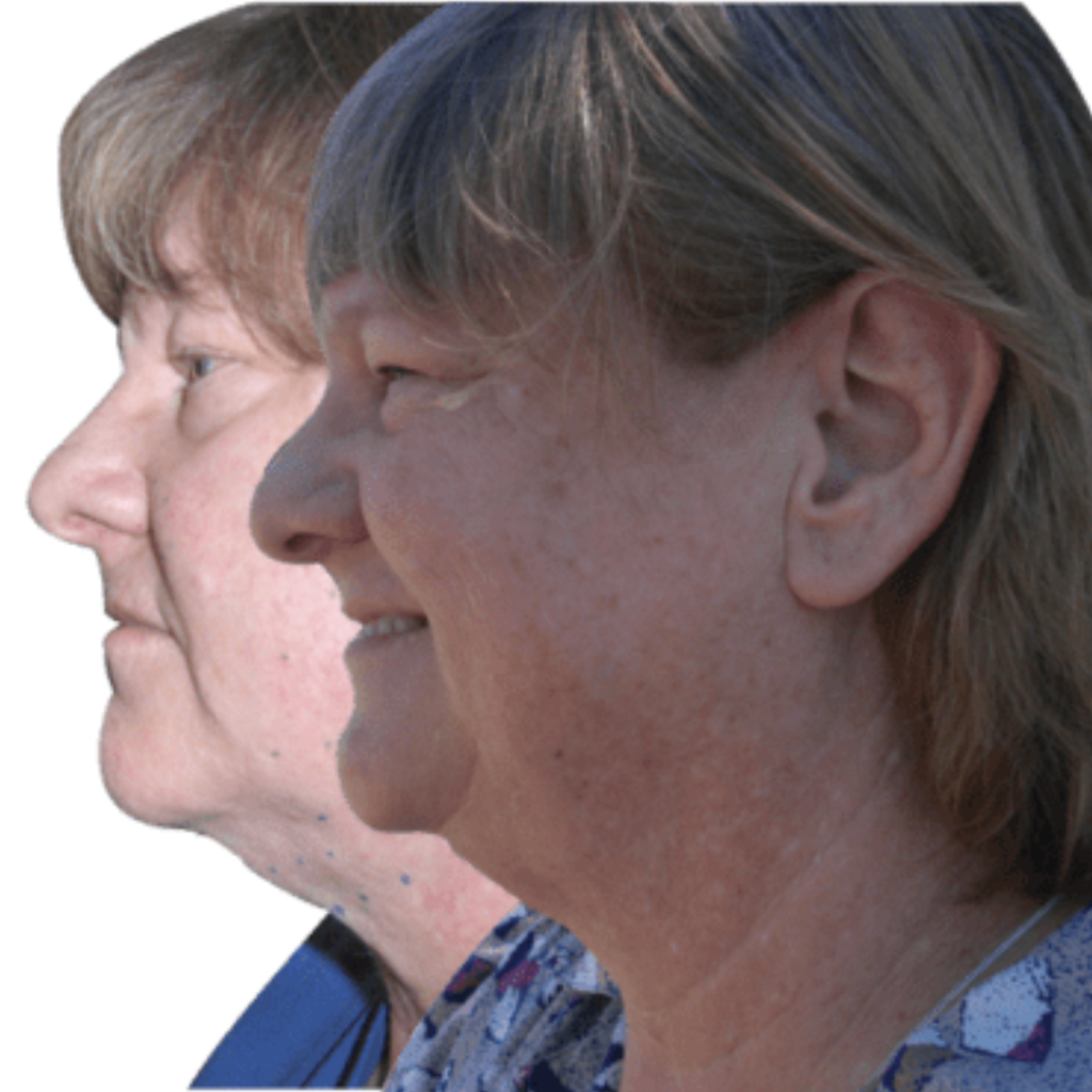 The Smart Lift - Dermacare Laser & Skin Care Clinics