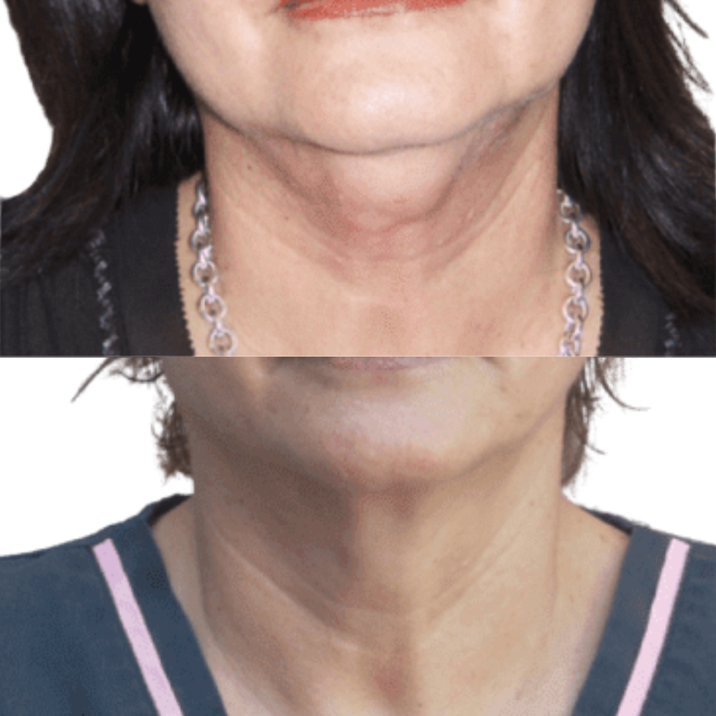The Smart Lift - Dermacare Laser & Skin Care Clinics